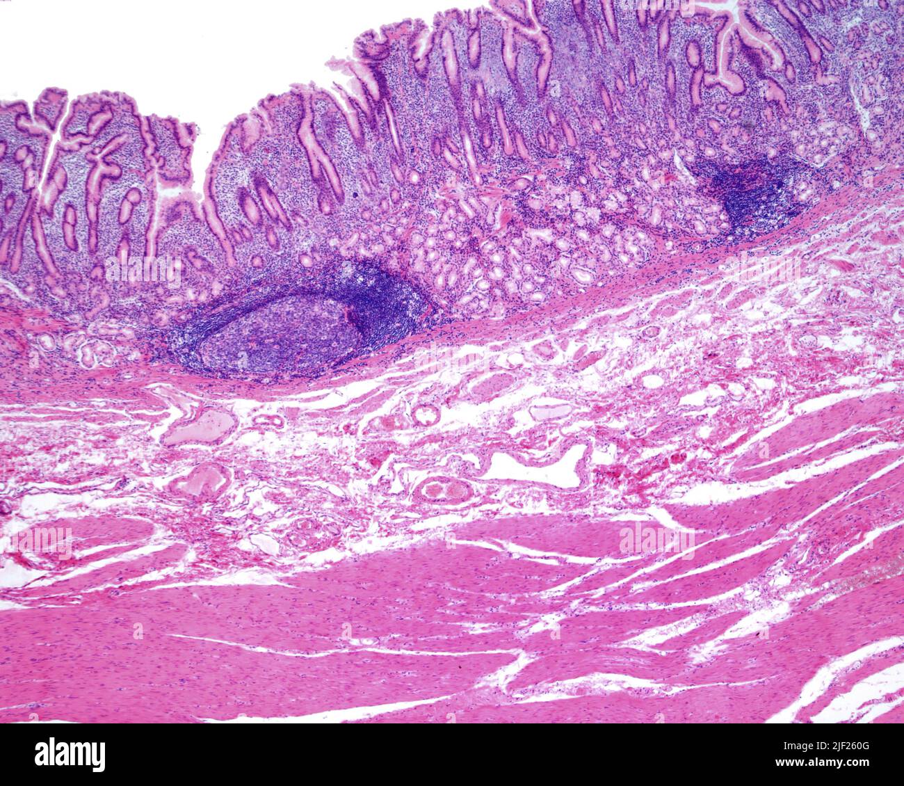 Gastrite chronique. Micrographe léger de la muqueuse gastrique antrale ...