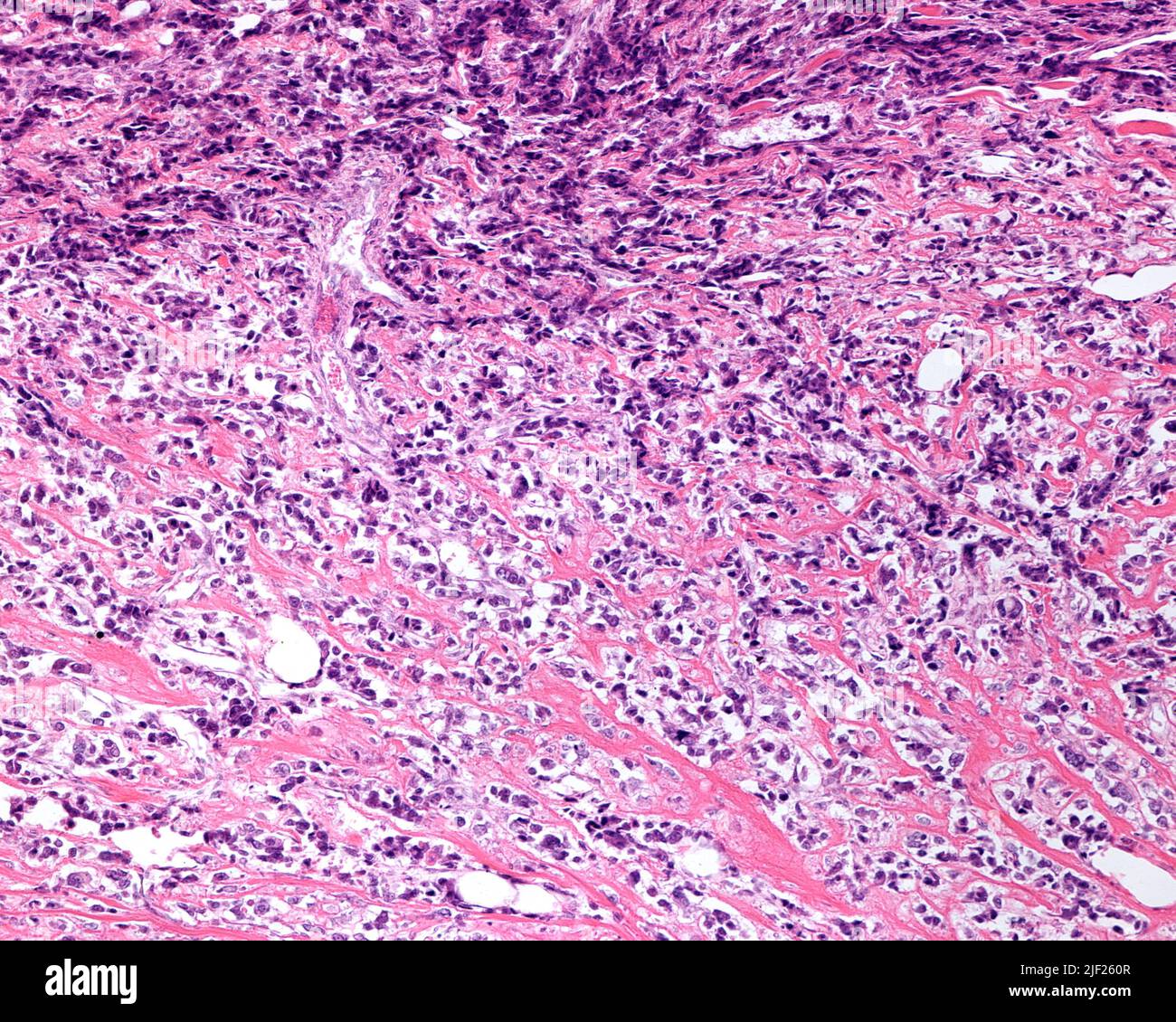 Cancer des os du sarcome ostéogénique. Micrographe léger montrant des ...