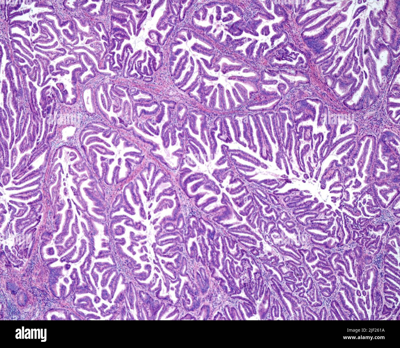Micrographe léger du carcinome de l'endometroïde montrant une structure ...
