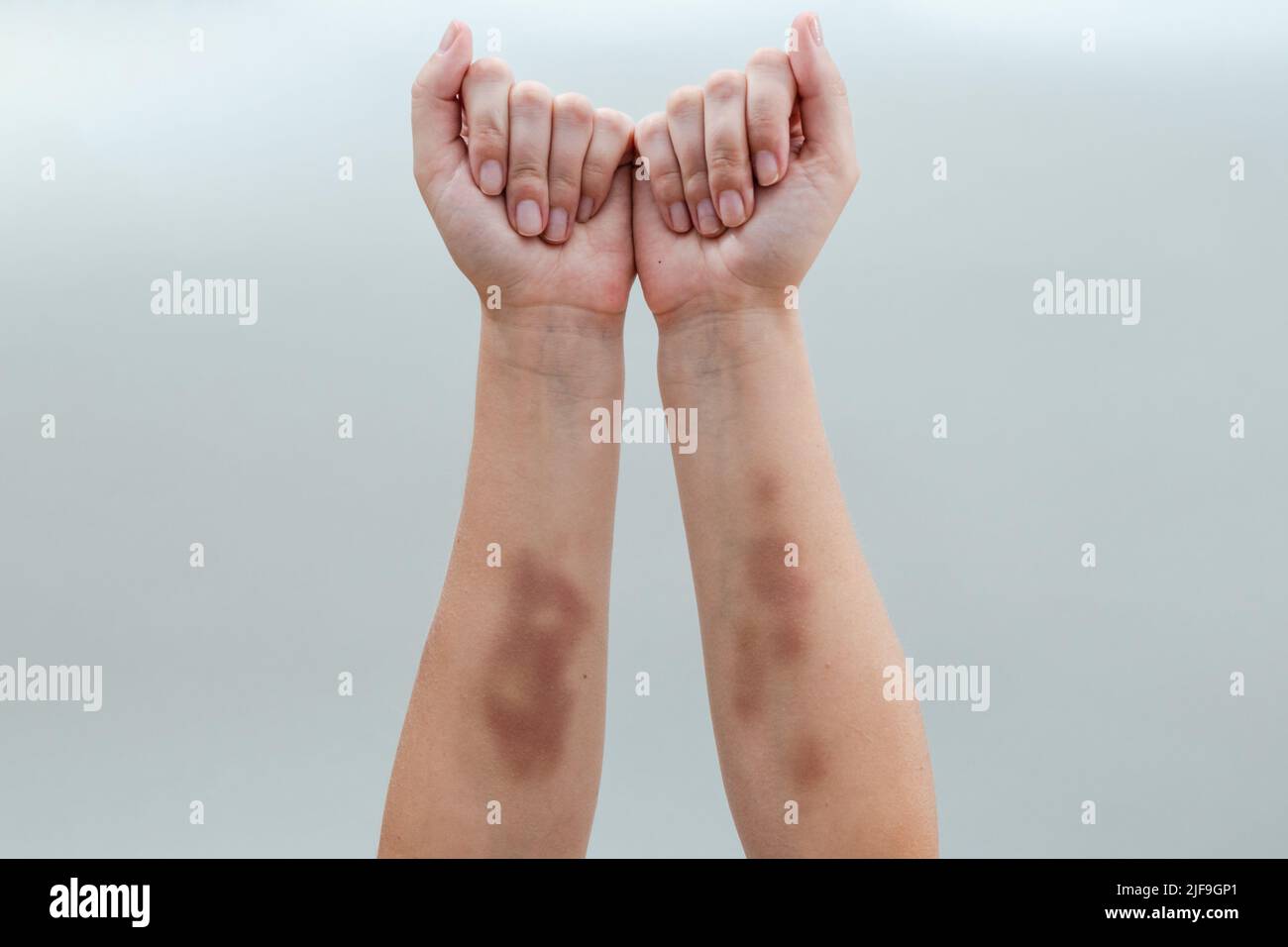 Cicatrice et ecchymoses Banque de photographies et d’images à haute ...