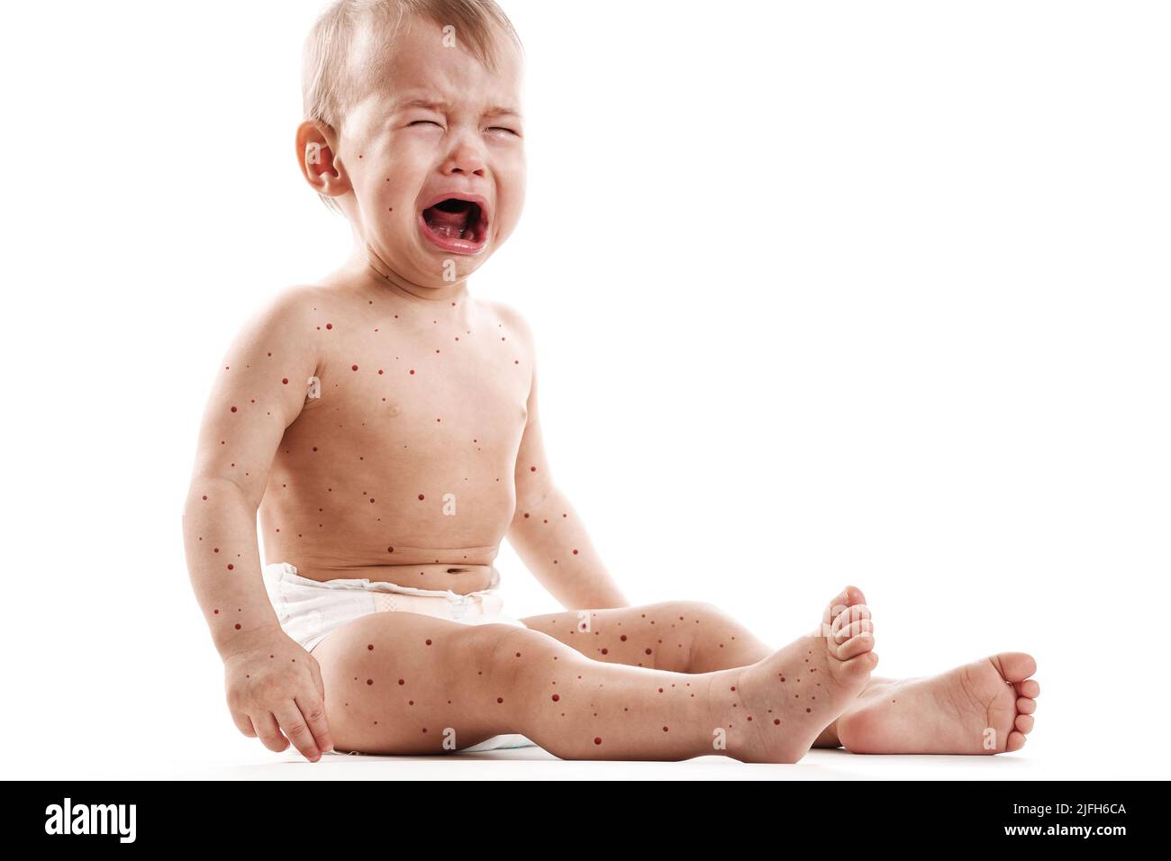 Bébé garçon avec la peau affectée par une éruption vésicules en raison ...