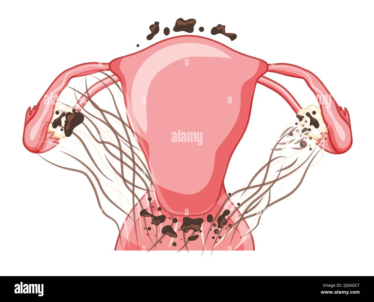 Endométriose 4 étapes douleur du système reproducteur féminin sopk ...