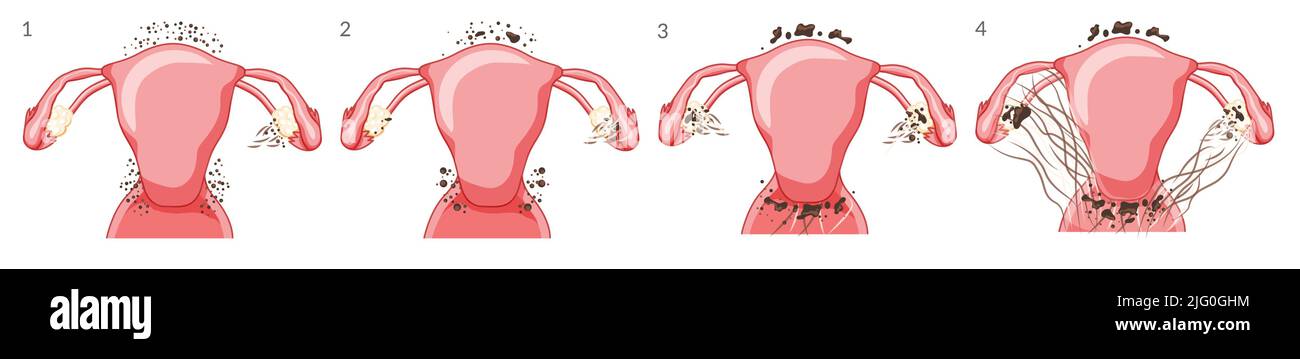 Ensemble d'endométriose 4 étapes système reproducteur féminin douleur ...