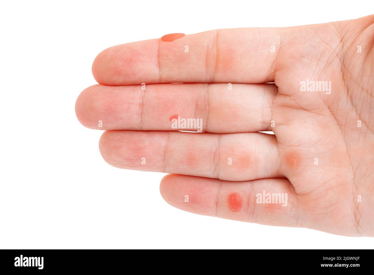 Blistered skin Banque de photographies et d’images à haute résolution ...