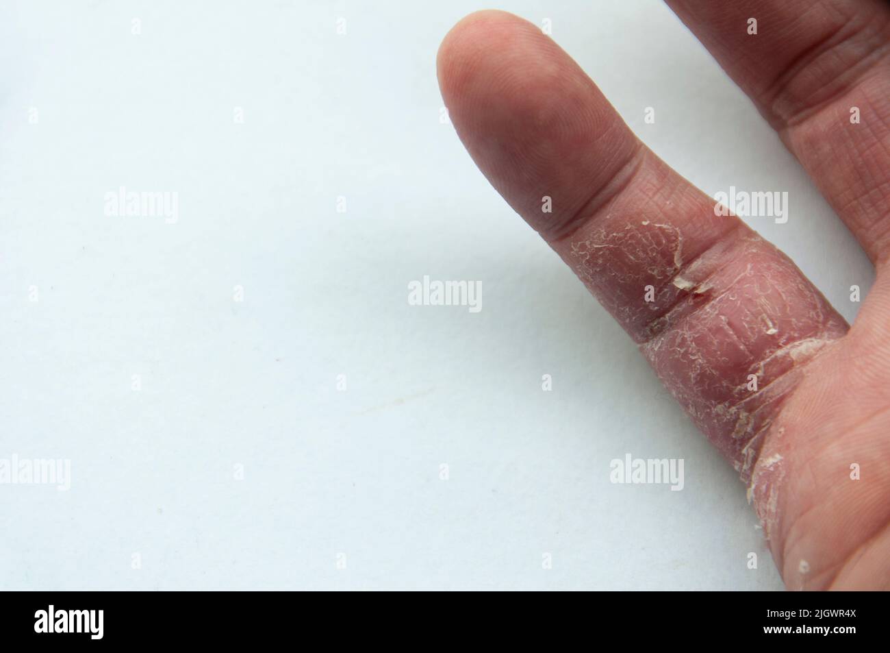 Maladie dermatologique Banque de photographies et d’images à haute ...