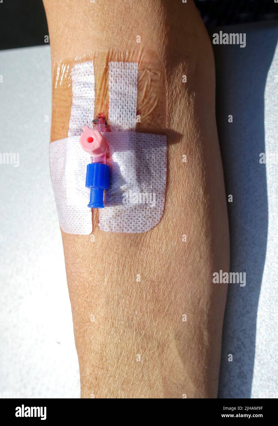 Cathéter veineux périphérique Banque de photographies et d’images à ...