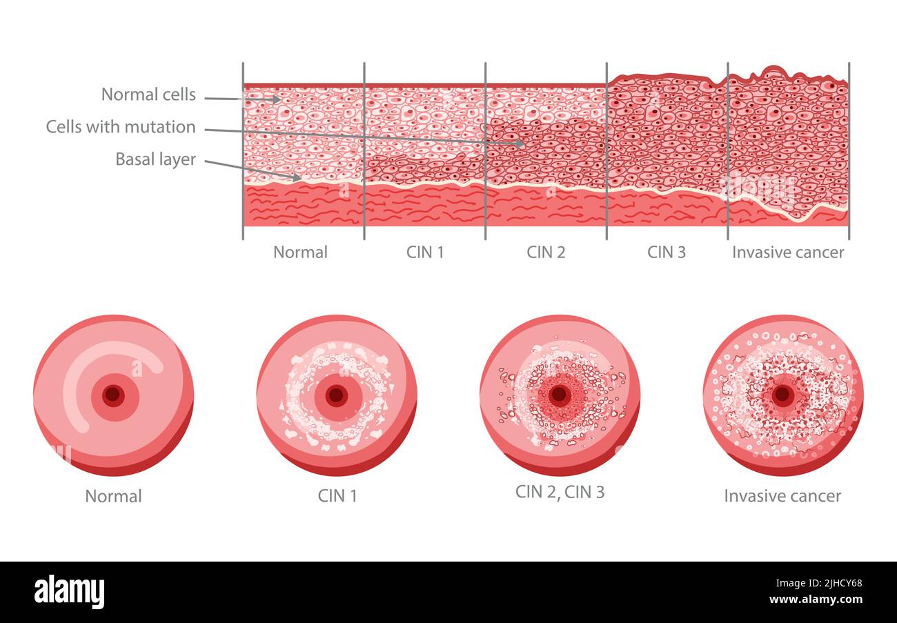 Cancer invasif du col utérin néoplasie intraépithéliale Dysplasie 1 2,3 ...