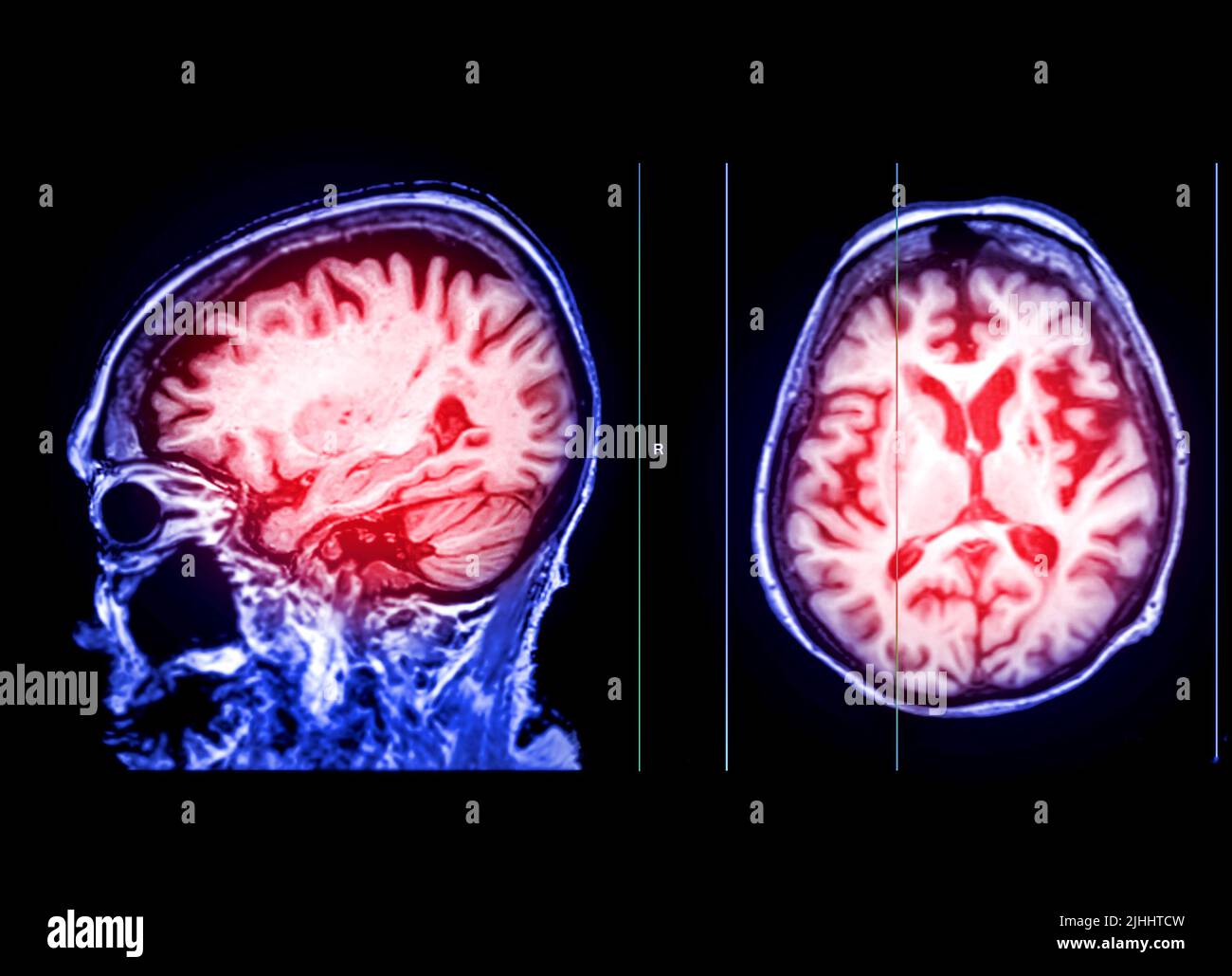 IRM cerveau sagittal et Axial T2 Flair technique pour détecter une ...