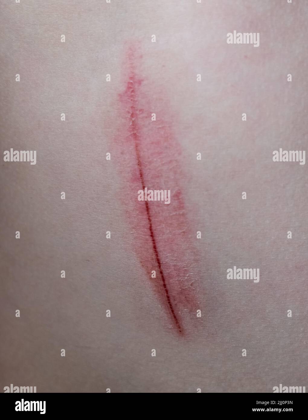 Abrasions cutanées Banque de photographies et d’images à haute ...