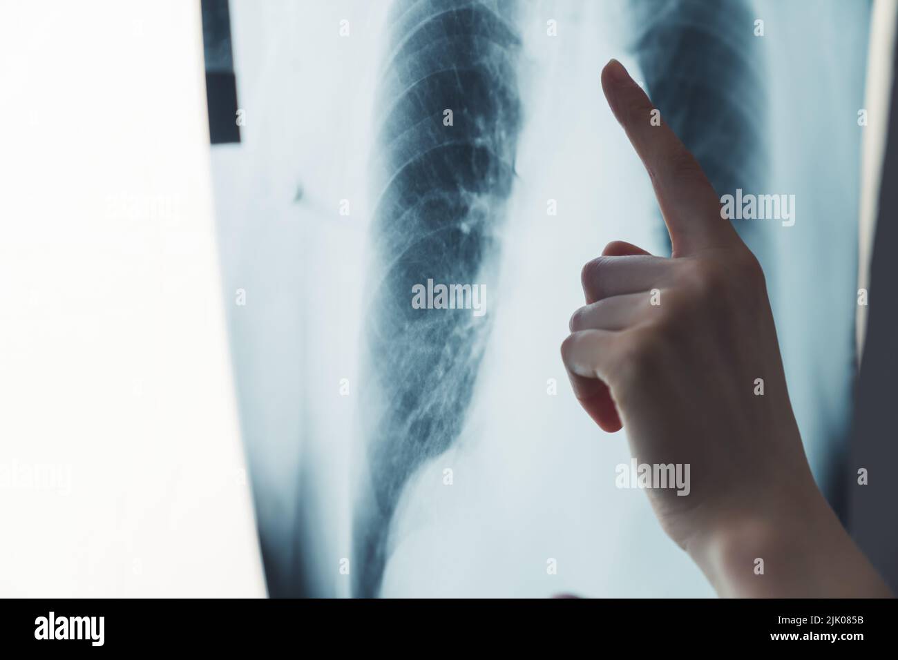 Le scanner thoracique des poumons Banque de photographies et d’images à ...