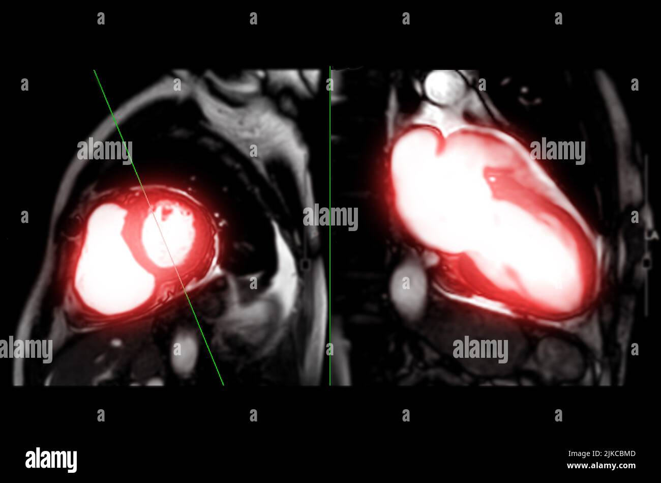 IRM cardiaque ou cardiaque IRM ( imagerie par résonance magnétique ) du ...