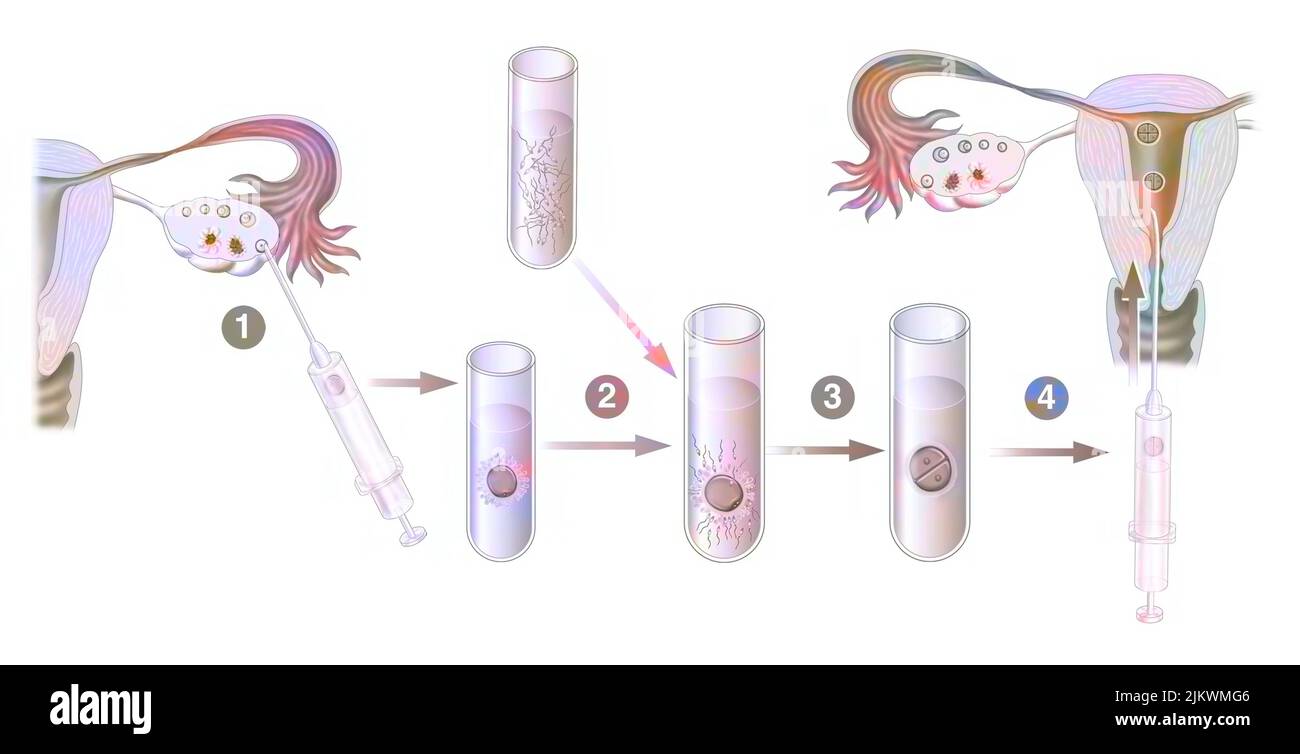 Schéma des différentes étapes de la fécondation in vitro Photo Stock ...