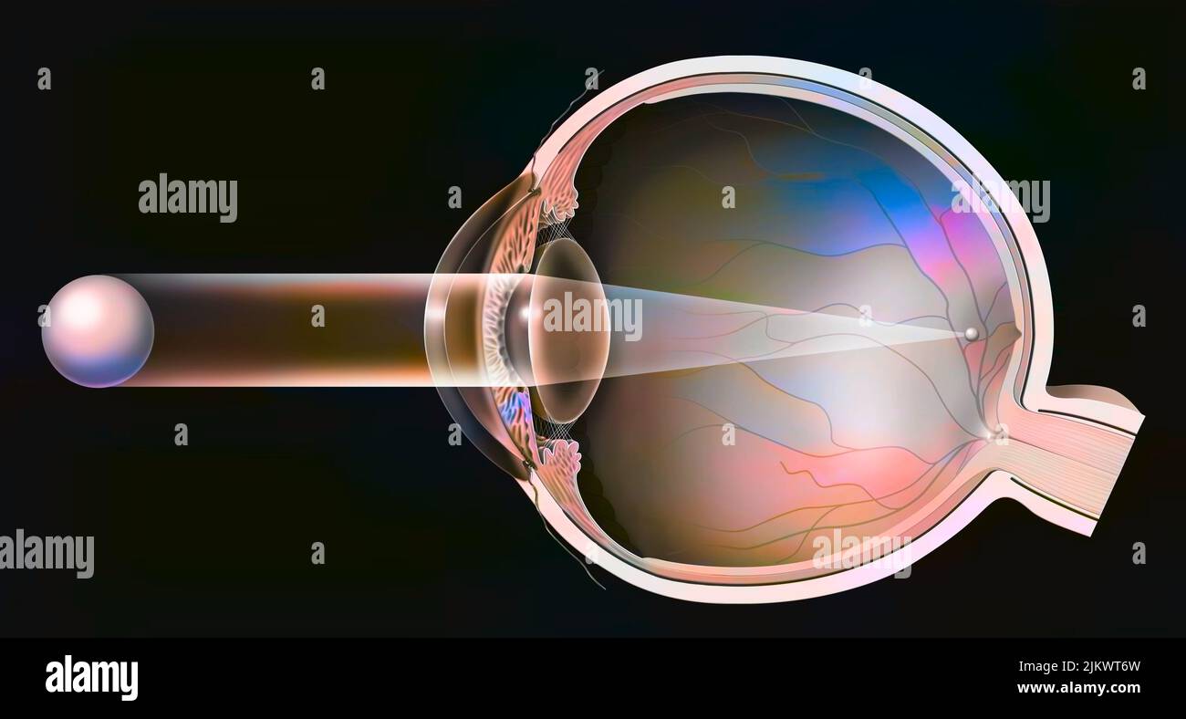 Oeil myope Banque de photographies et d’images à haute résolution - Alamy