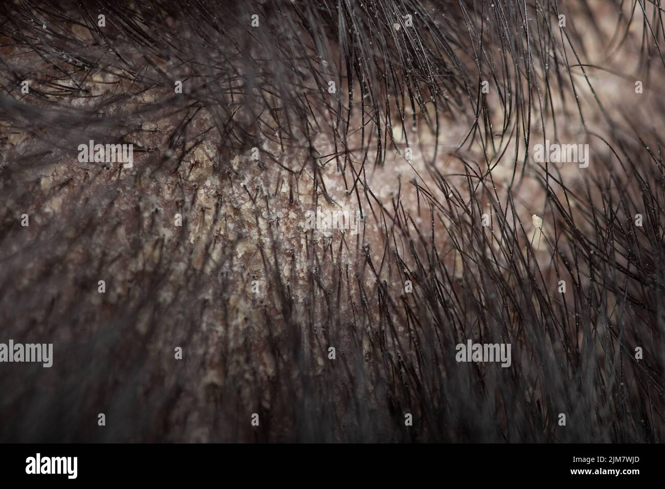 Gros plan de pellicules sur le cuir chevelu d'un homme. Problème de ...