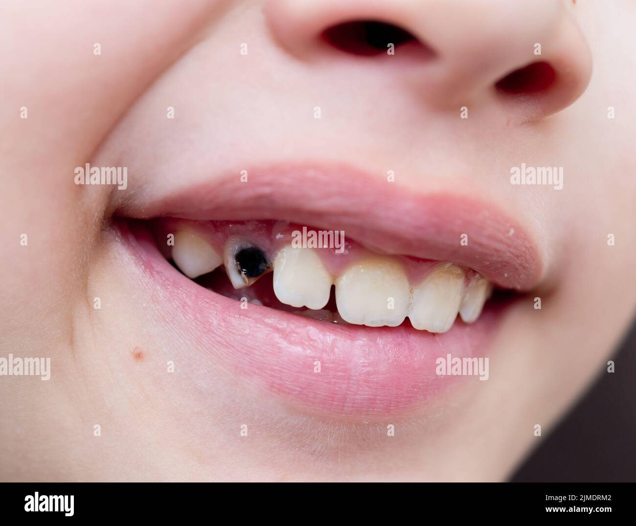 Baby teeth Banque de photographies et d’images à haute résolution - Alamy