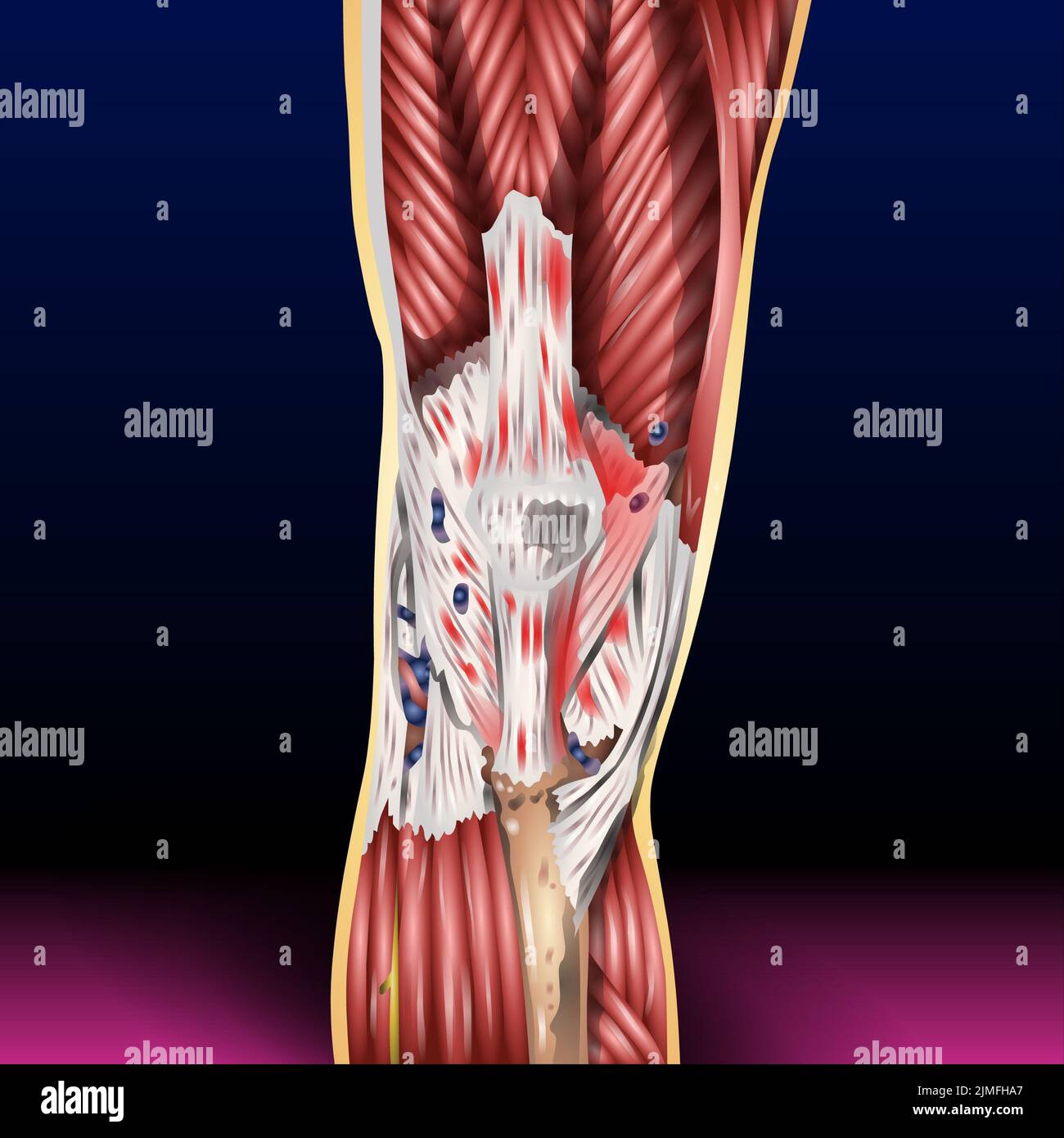 Tendinite dans la jambe Photo Stock - Alamy