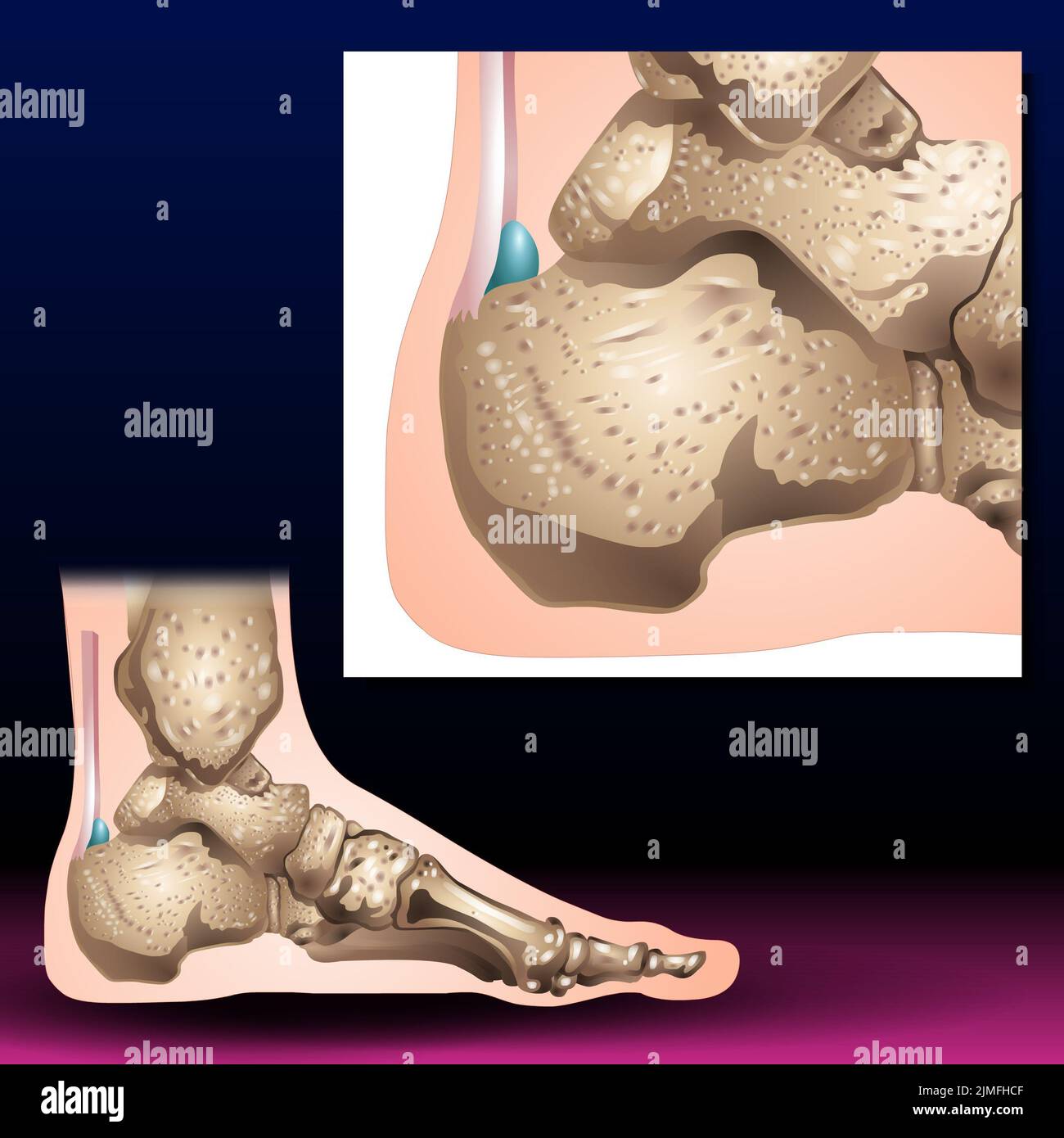 Fracture de l'orteil Banque de photographies et d’images à haute ...