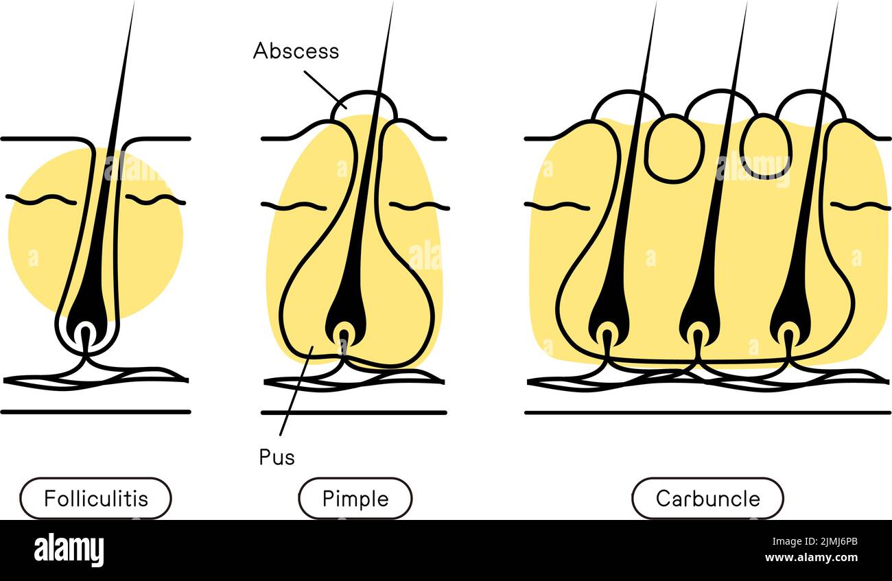 Inflammation de la peau schéma Banque de photographies et d’images à ...