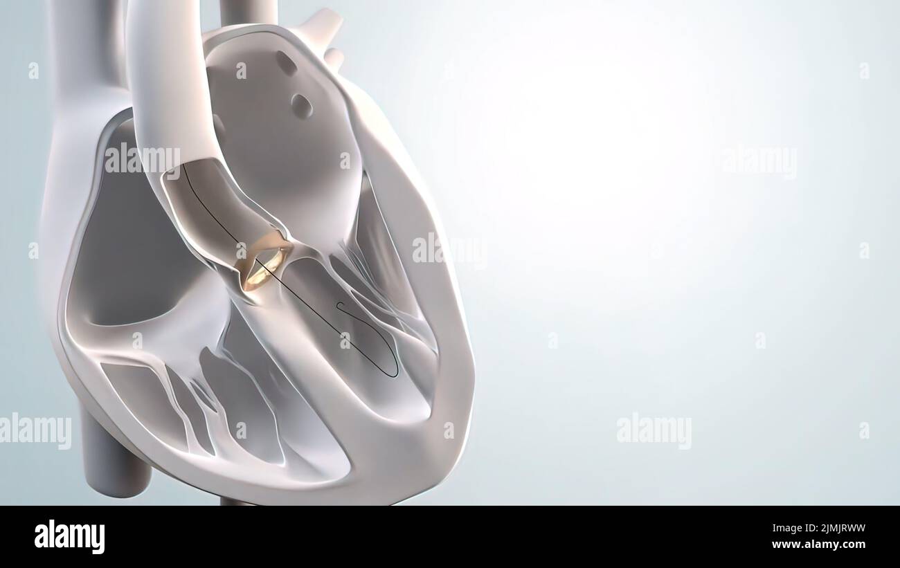 L'appareil cardiovasculaire. 3D médical 3D rendu de la dilatation de la ...