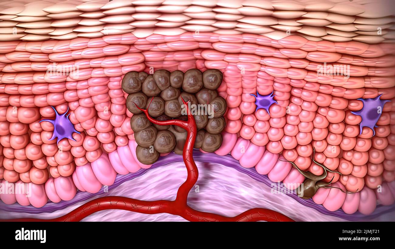 Carcinome basocellulaire infiltrant Banque de photographies et d’images ...