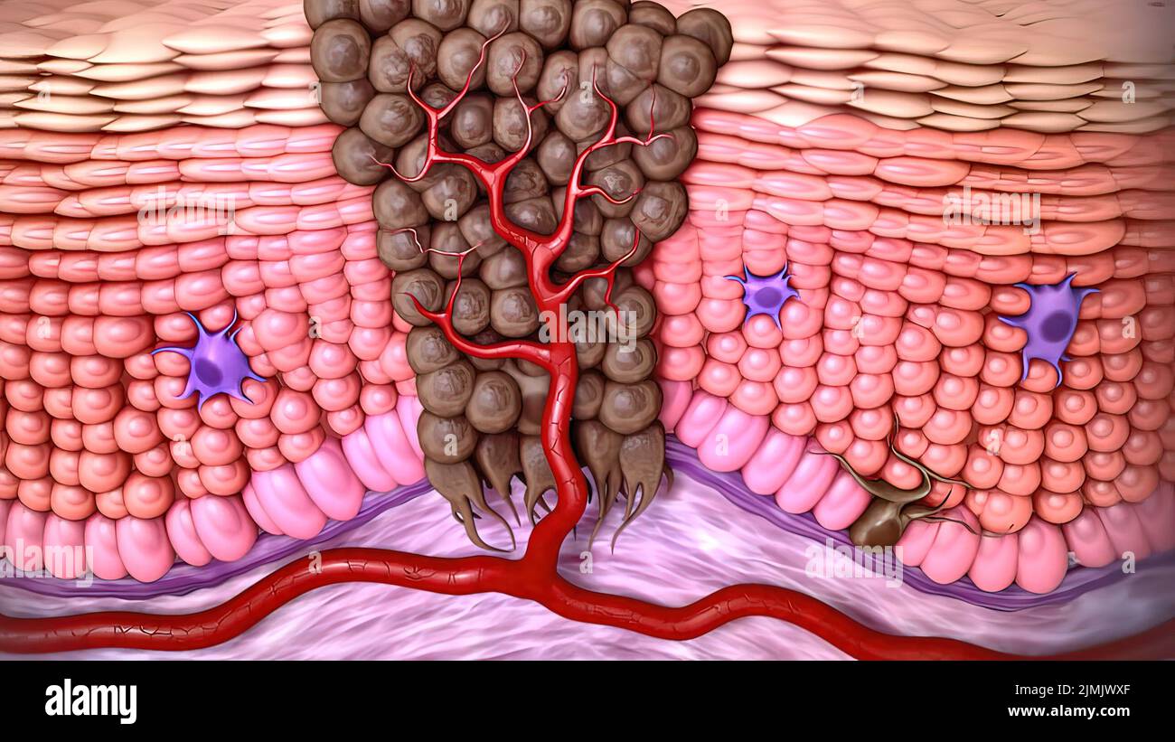 Carcinome basocellulaire infiltrant Banque de photographies et d’images ...