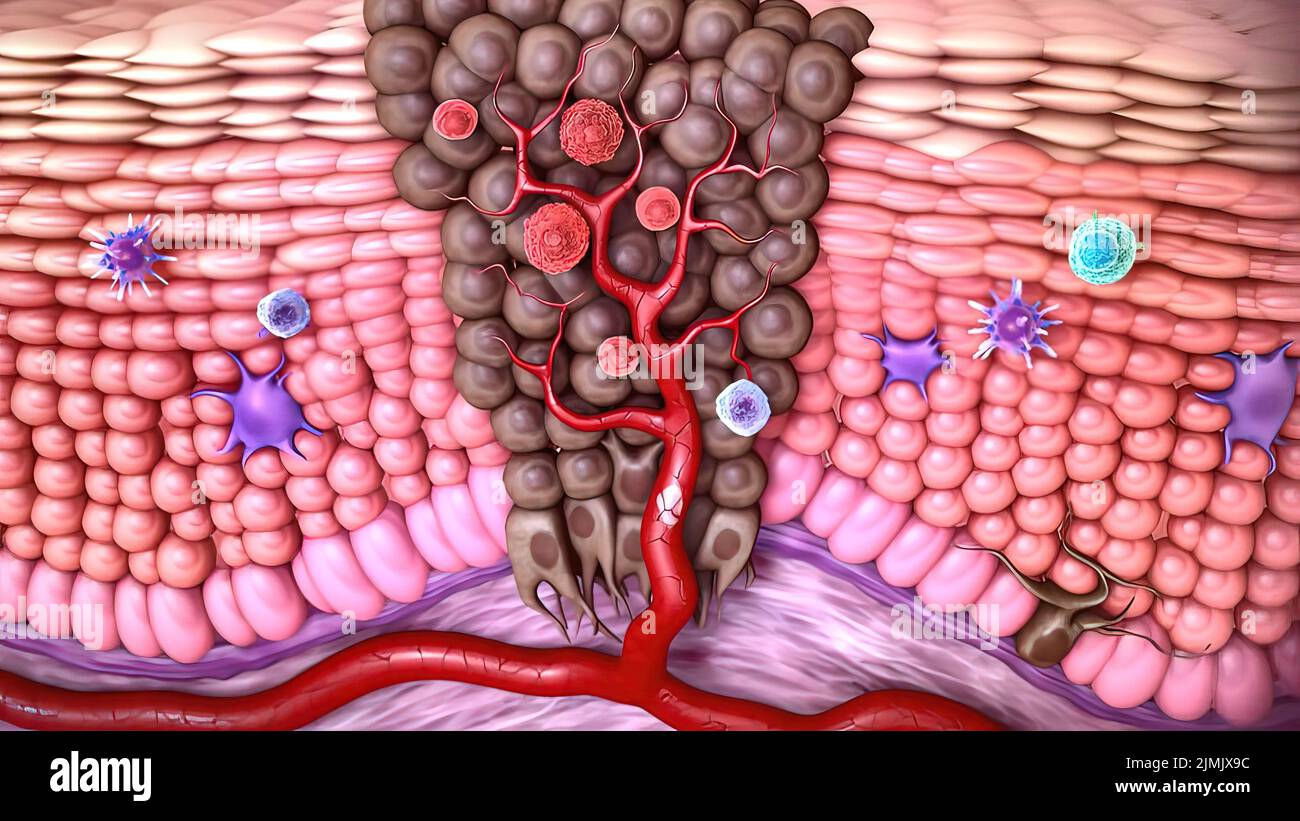Carcinome basocellulaire infiltrant Banque de photographies et d’images ...