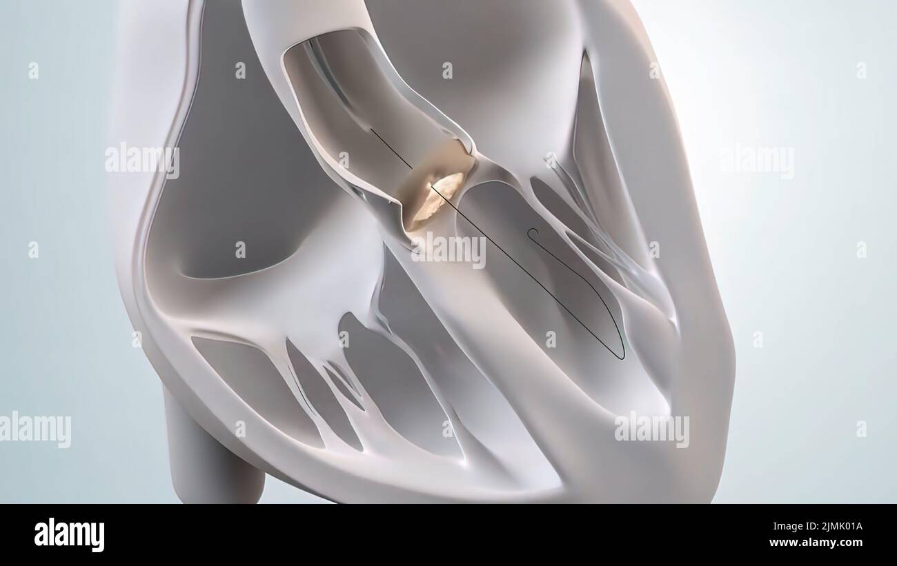 L'appareil cardiovasculaire. 3D médical 3D rendu de la dilatation de la ...