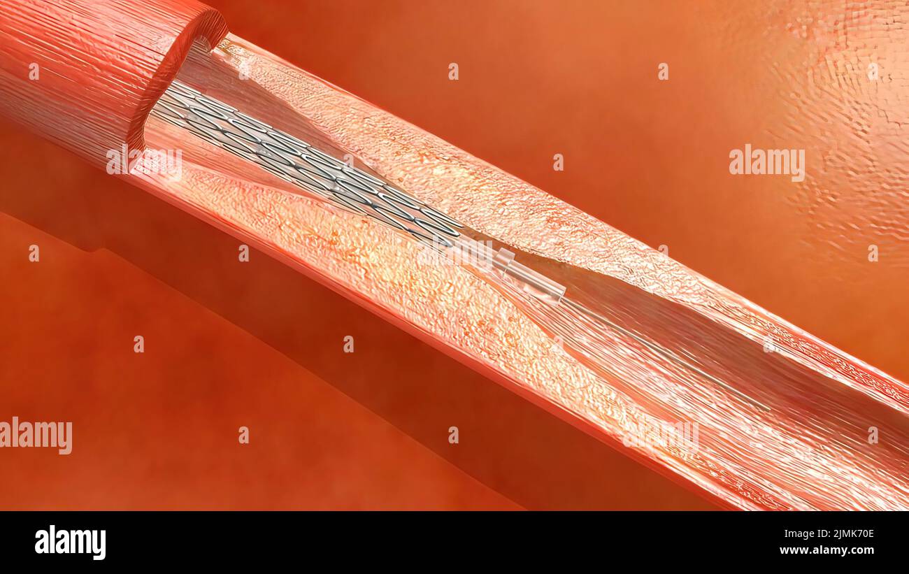 Les cellules d'hémoglobine qui traversent un artère bloquée causent la ...