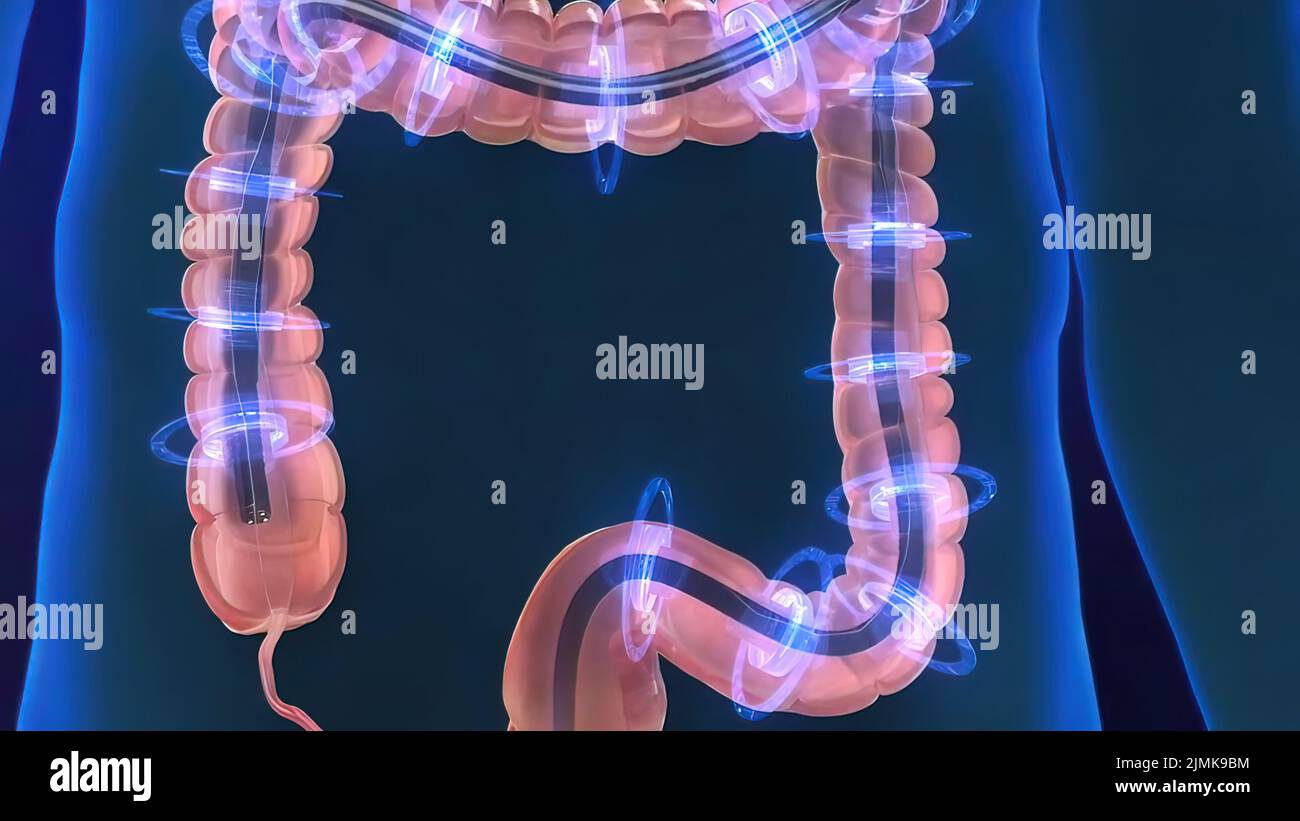 Endoscopic procedure Banque de photographies et d’images à haute ...