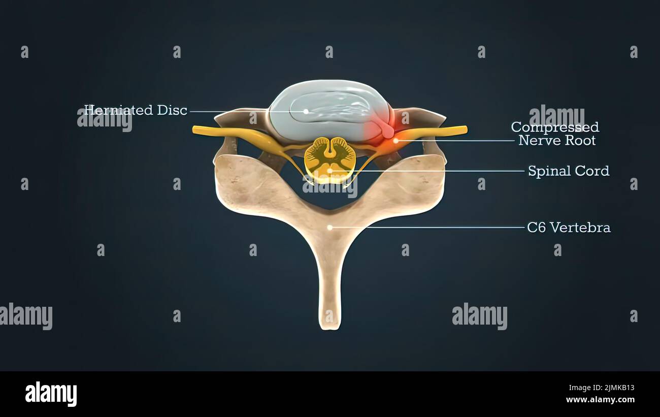Vértebra lumbar Banque de photographies et d’images à haute résolution ...