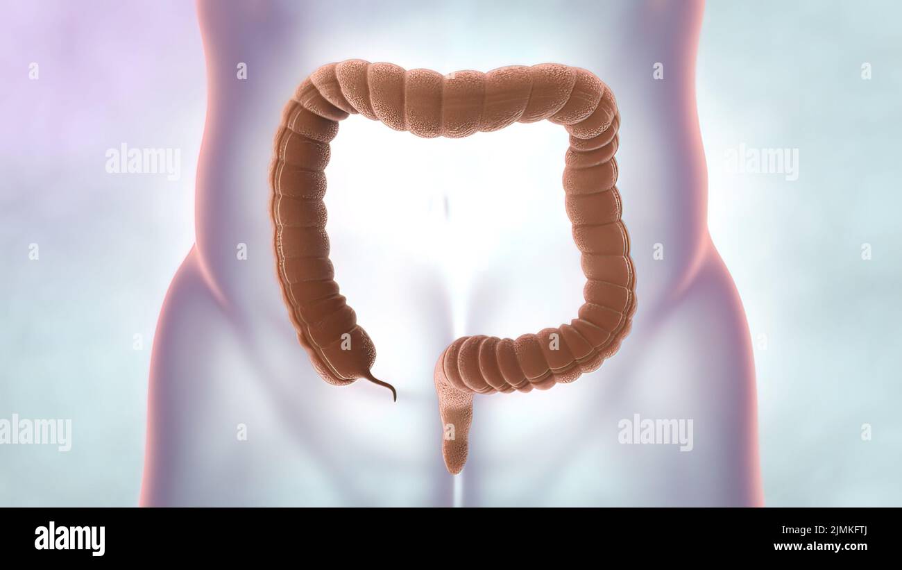 Colon cancer rectum Banque de photographies et d’images à haute ...