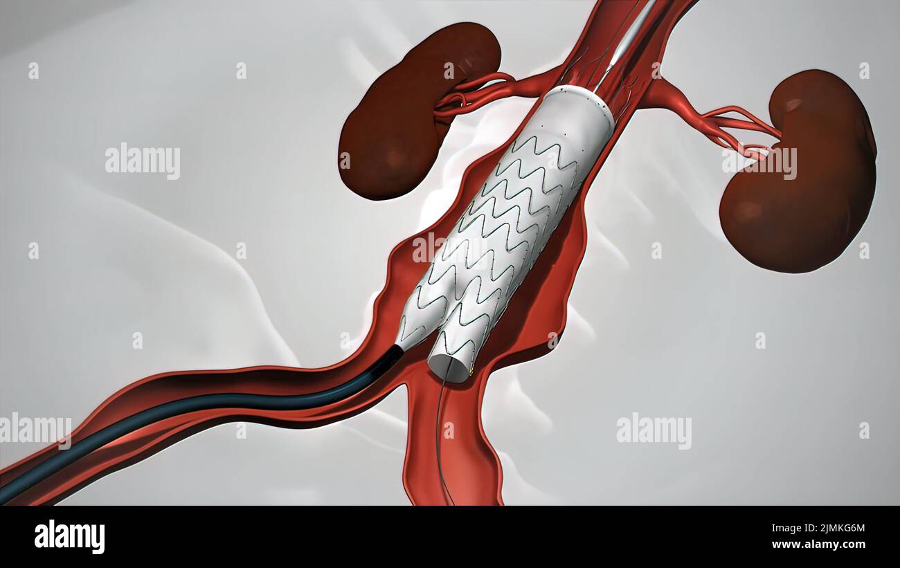 Stent procedure Banque de photographies et d’images à haute résolution ...