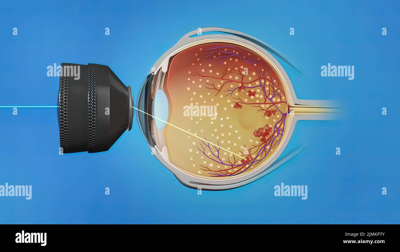 Chirurgie oculaire au laser Banque de photographies et d’images à haute ...