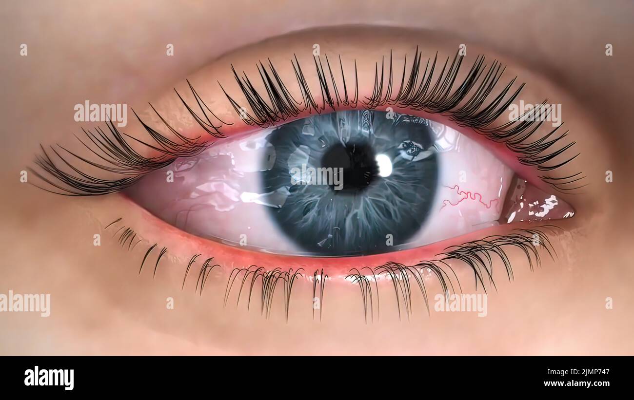 Maladie inflammatoire de l'intestin ibd Banque de photographies et d ...