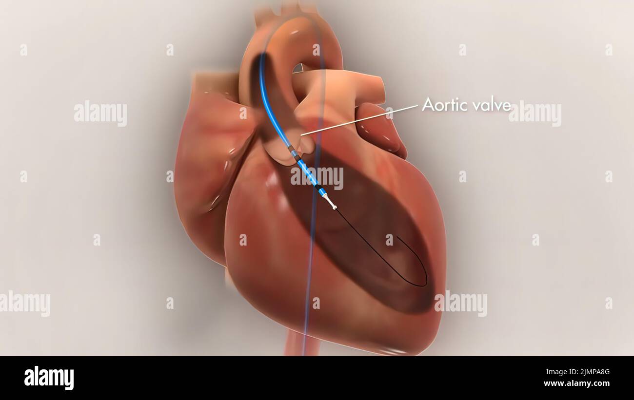 Coronary angioplasty stent insertion Banque de photographies et d ...