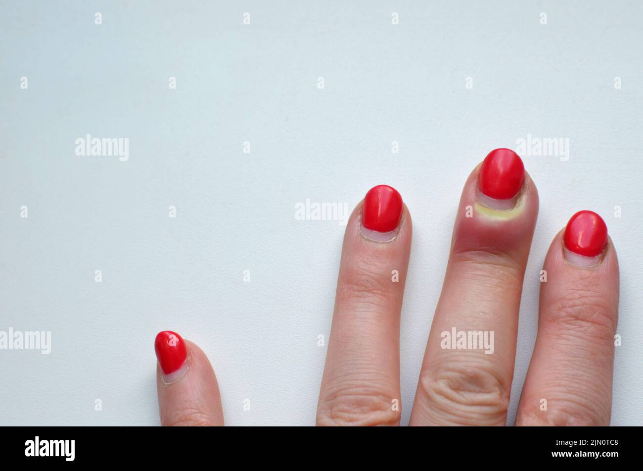 Skin reddened by infection Banque de photographies et d’images à haute ...