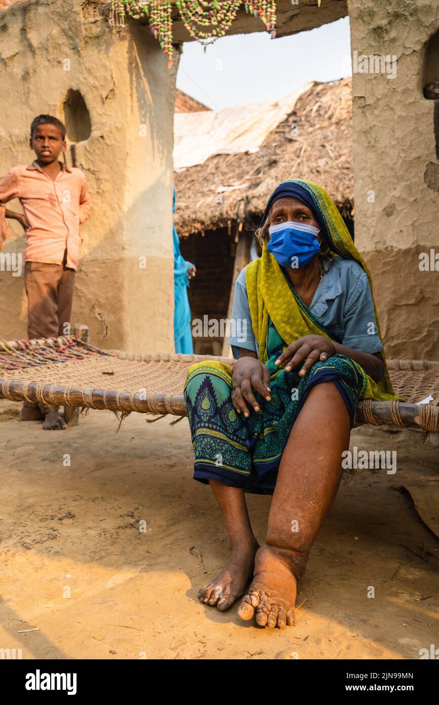 La filariose est une maladie infectieuse tropicale causée par un des ...