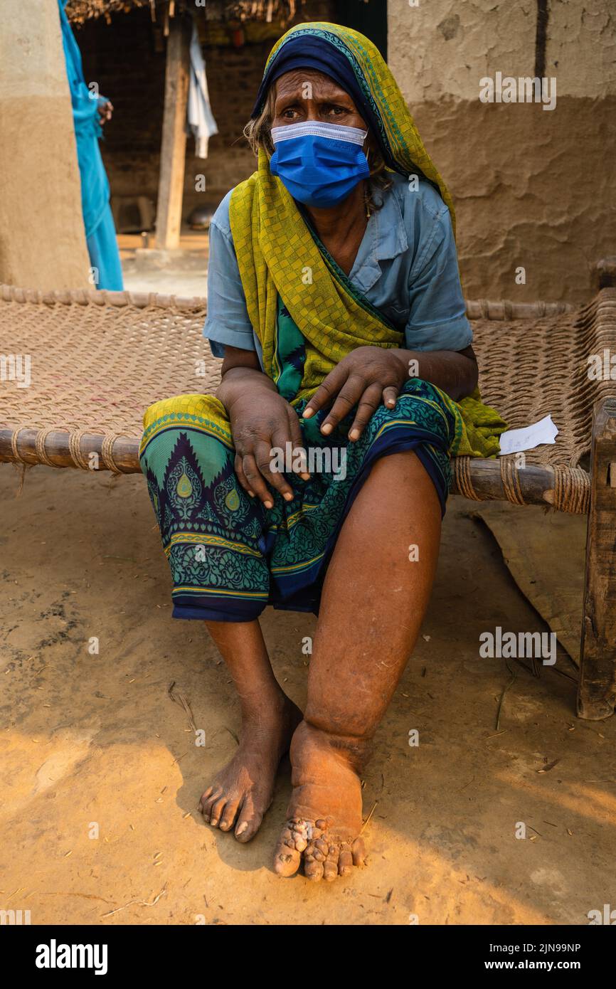 La filariose est une maladie infectieuse tropicale causée par un des ...