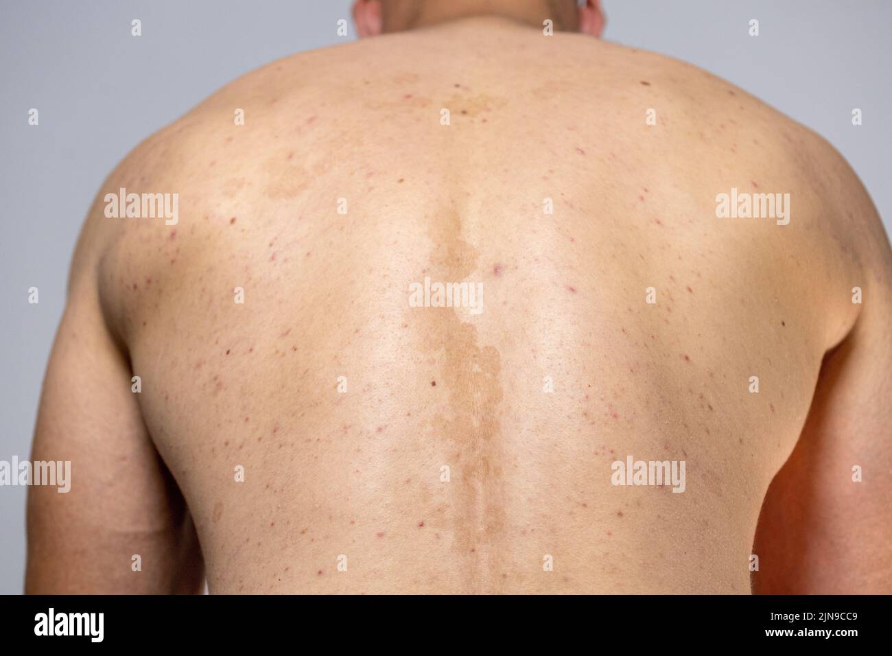 tinea versicolor sur le dos. pityriasis versicolor problème avec la ...