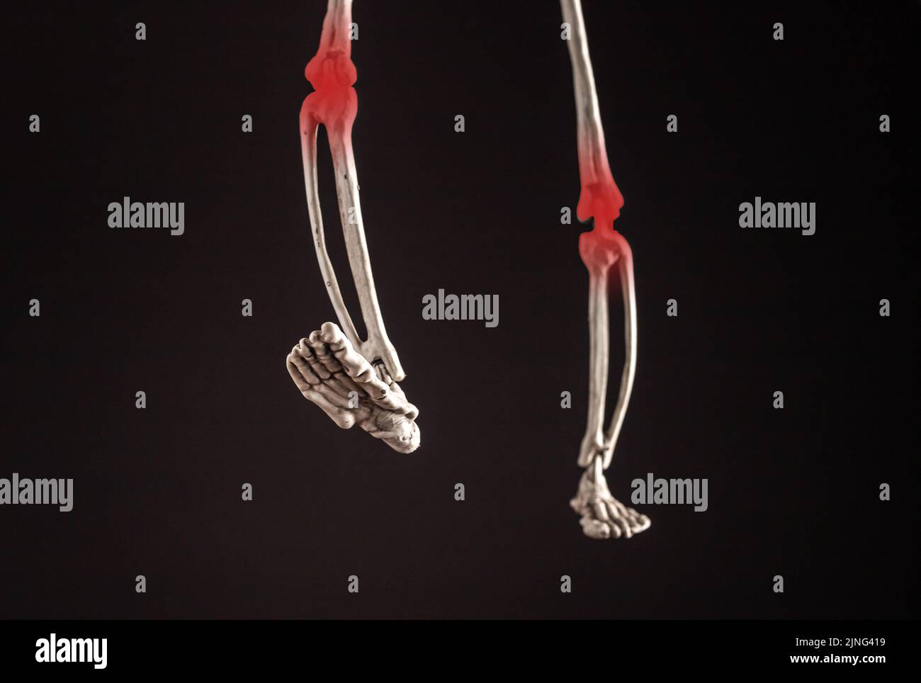 Bursite du genou Banque de photographies et d’images à haute résolution ...