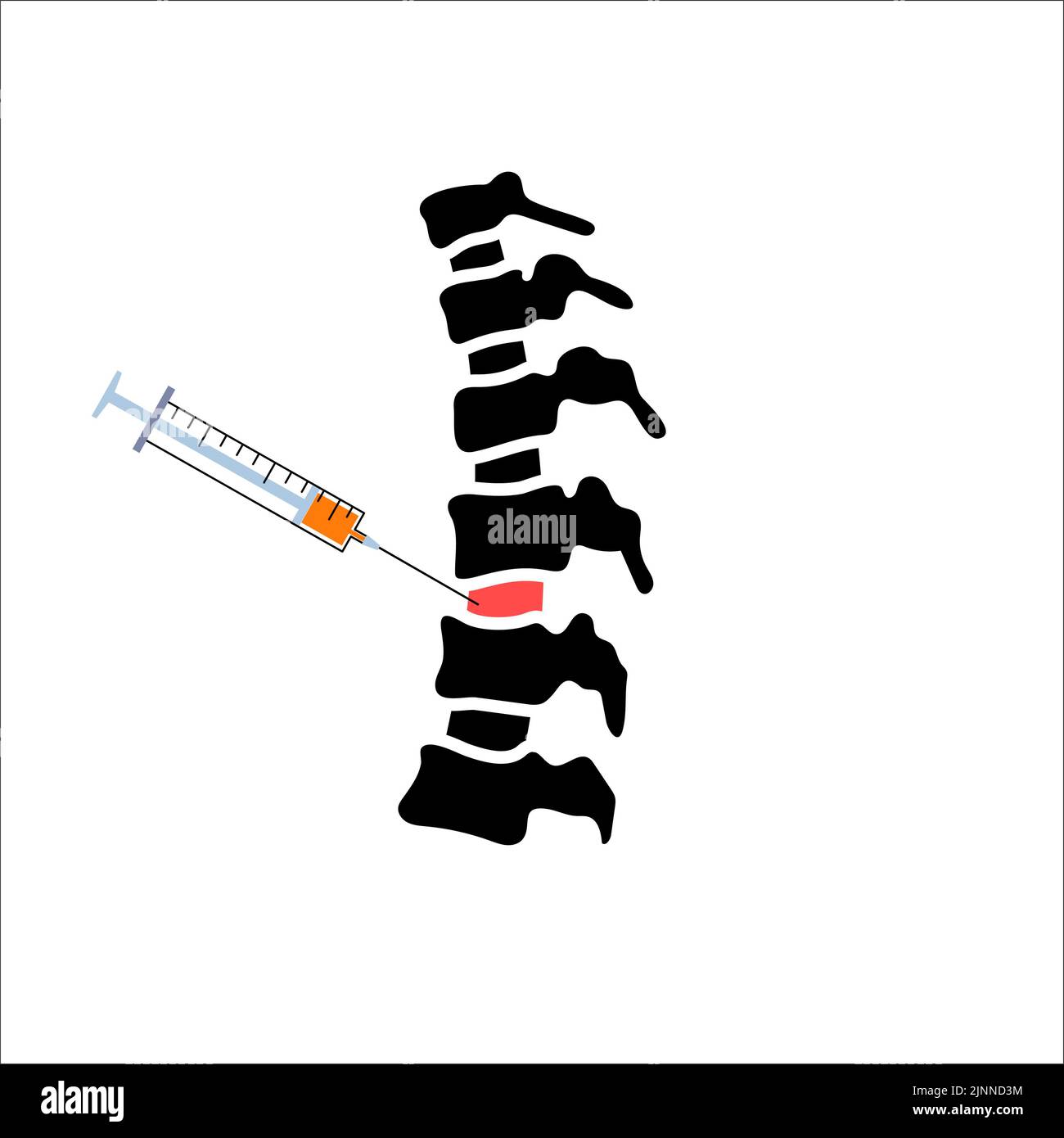 Injection rachidienne, illustration Photo Stock - Alamy