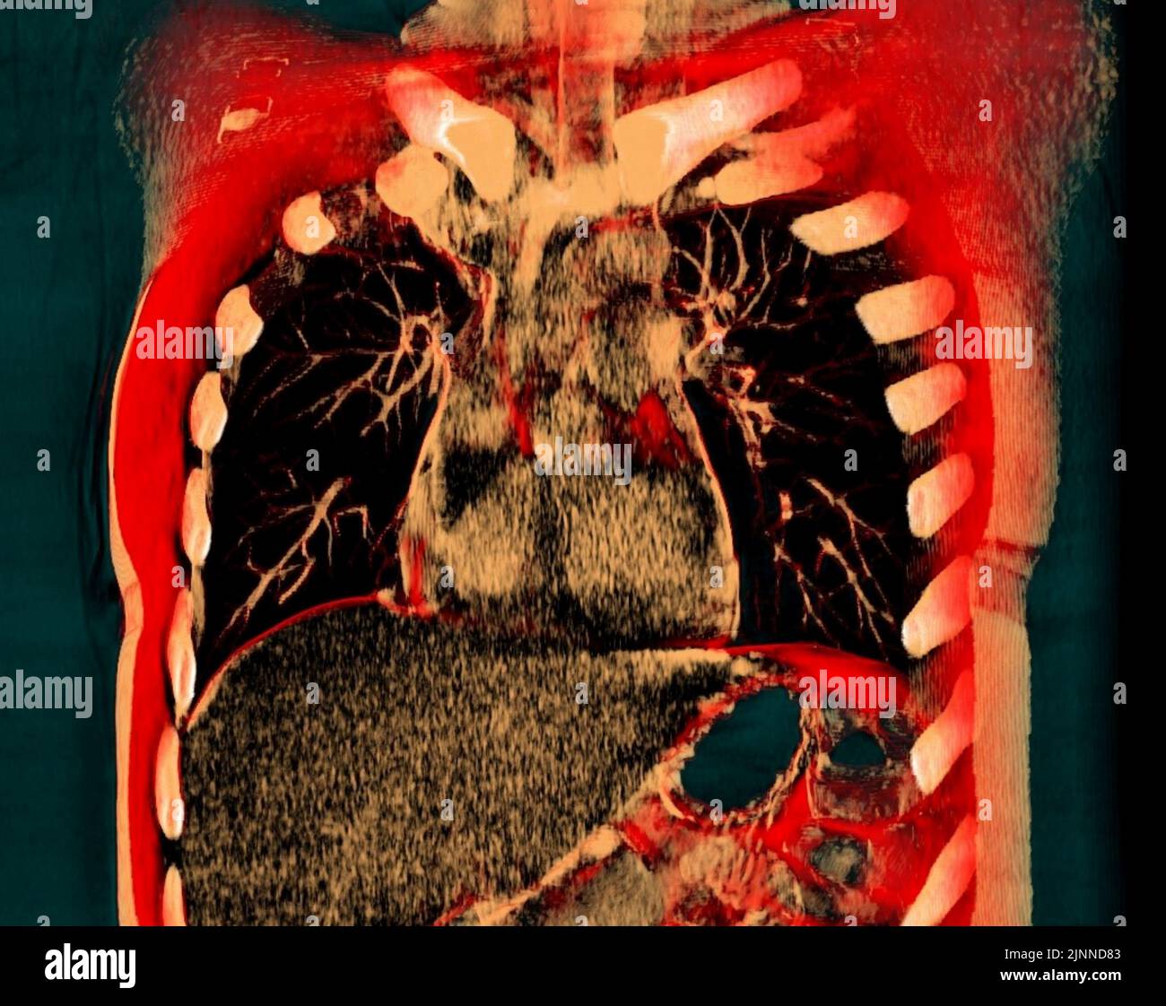 Poumons normaux thorax normal Banque de photographies et d’images à ...