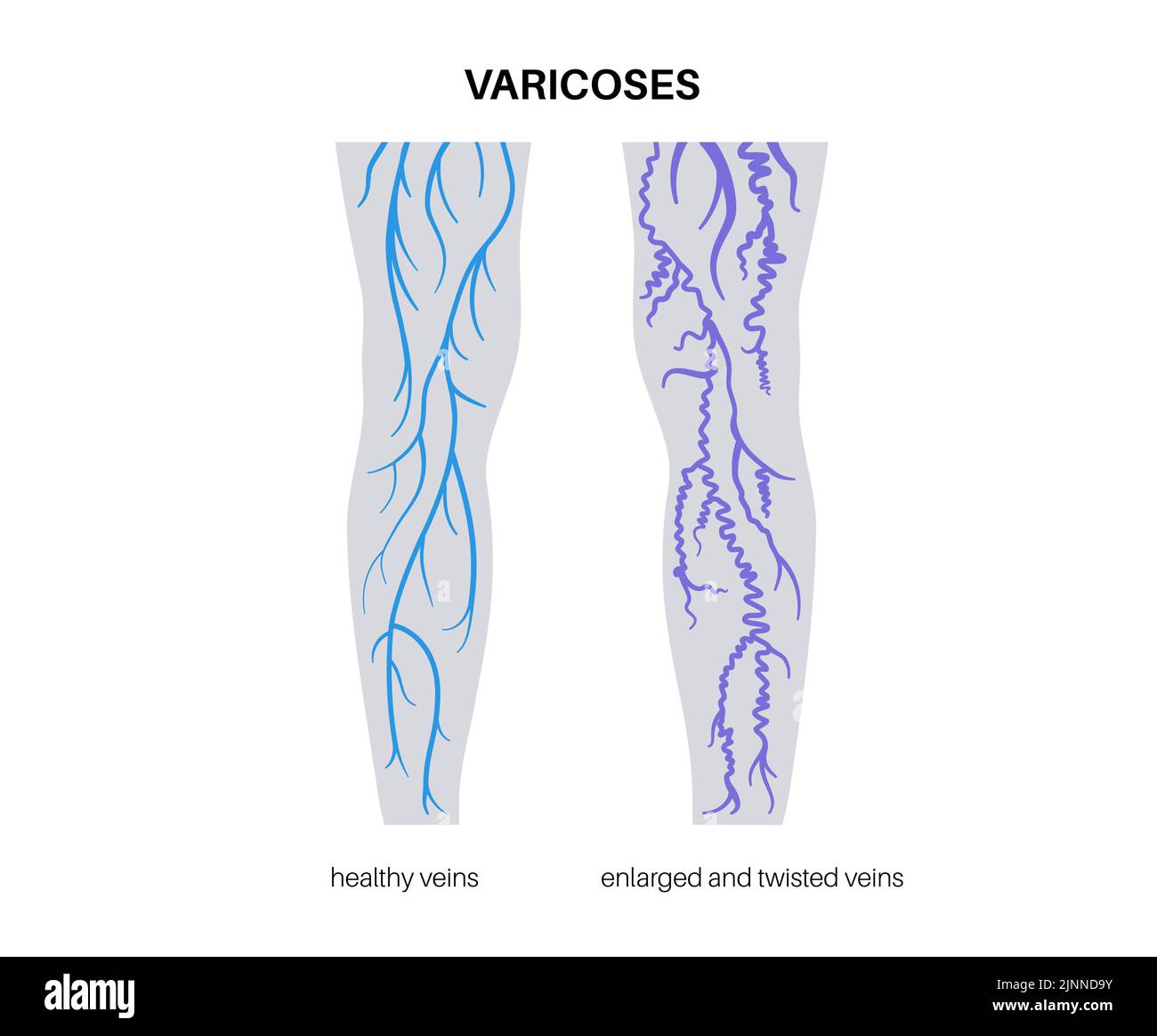 Varicose veins swollen enlarged veins Banque de photographies et d ...