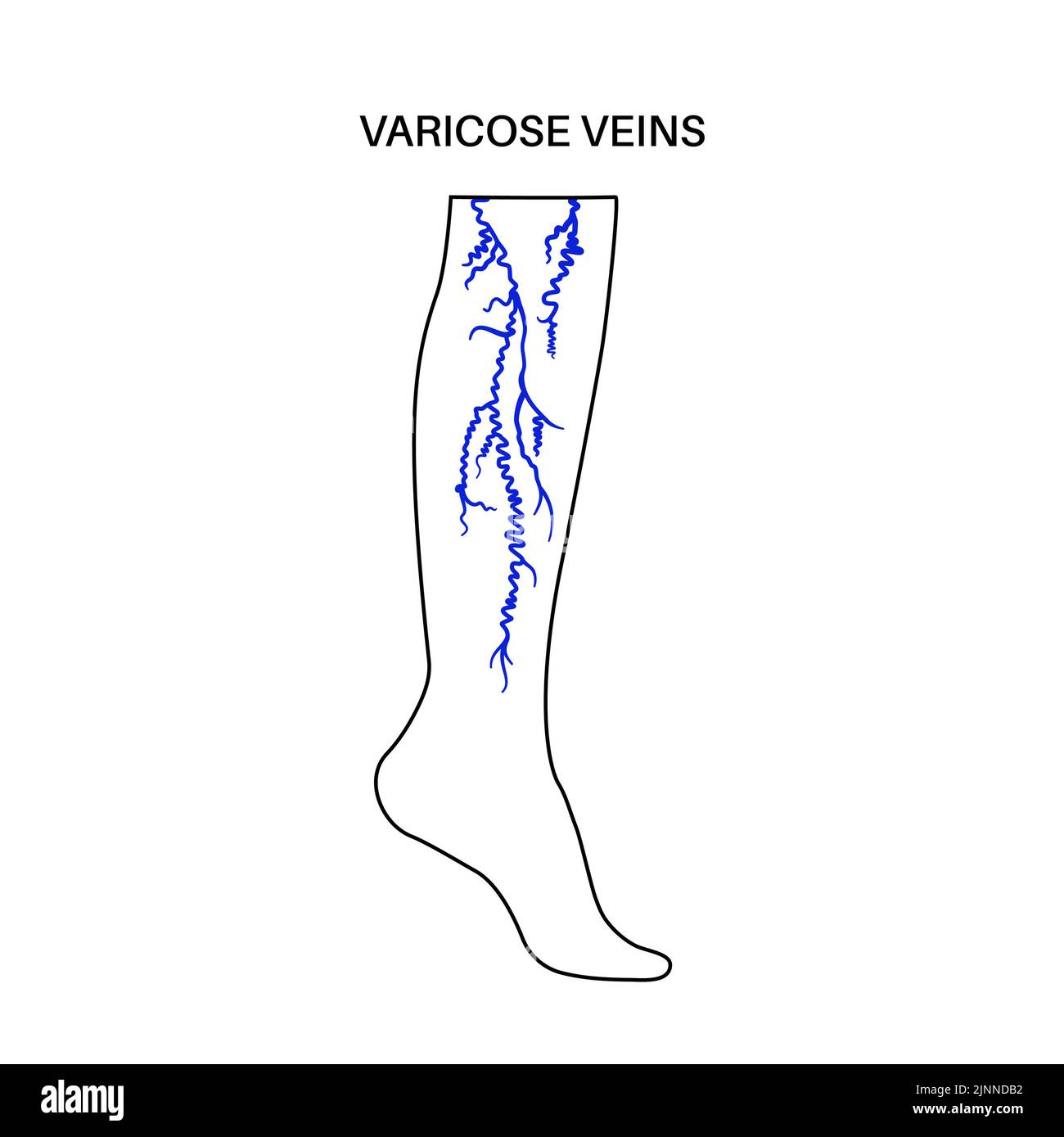 Varicose veins leg Banque d'images détourées - Alamy