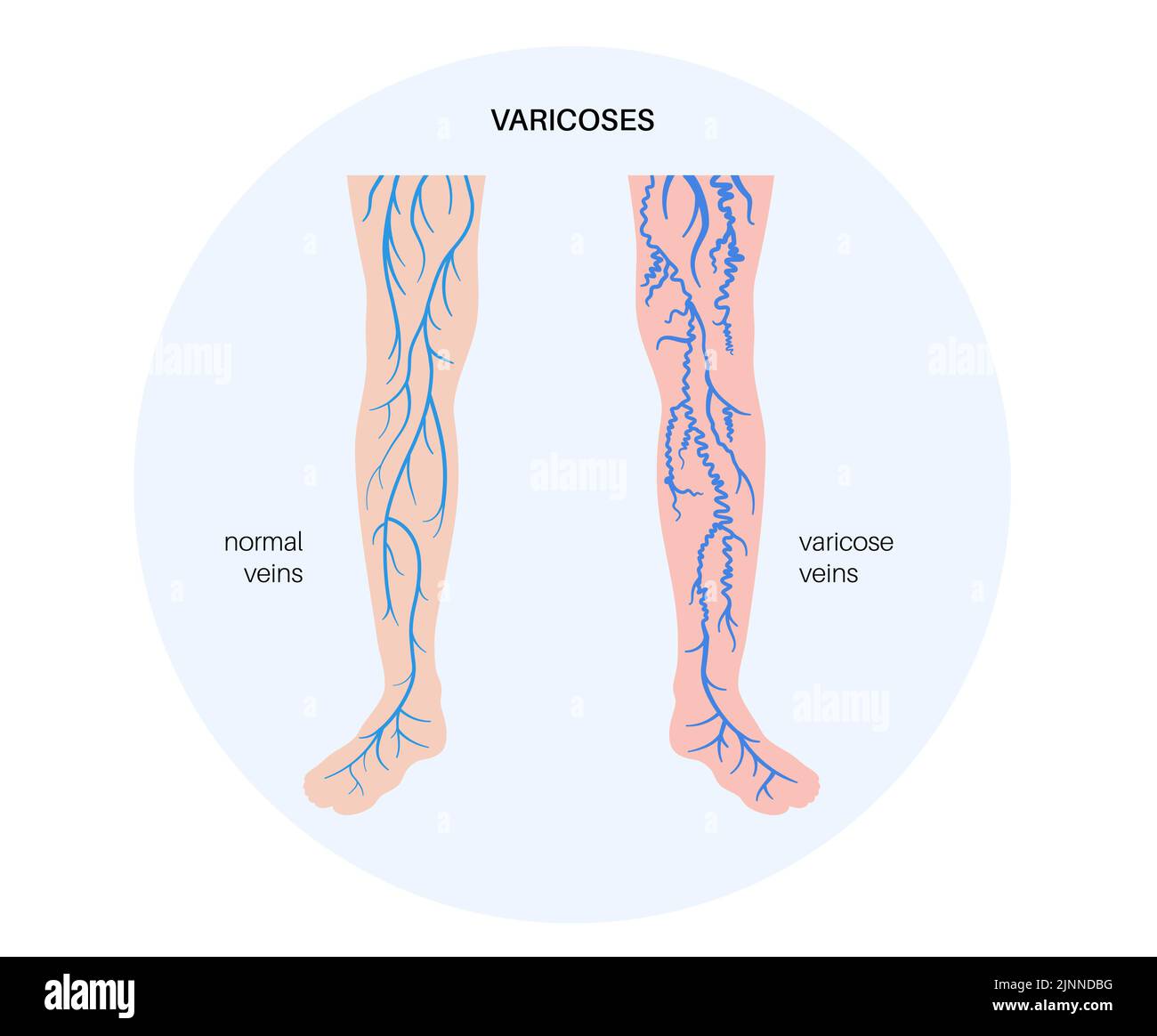 Varicose veins swollen enlarged veins Banque de photographies et d ...