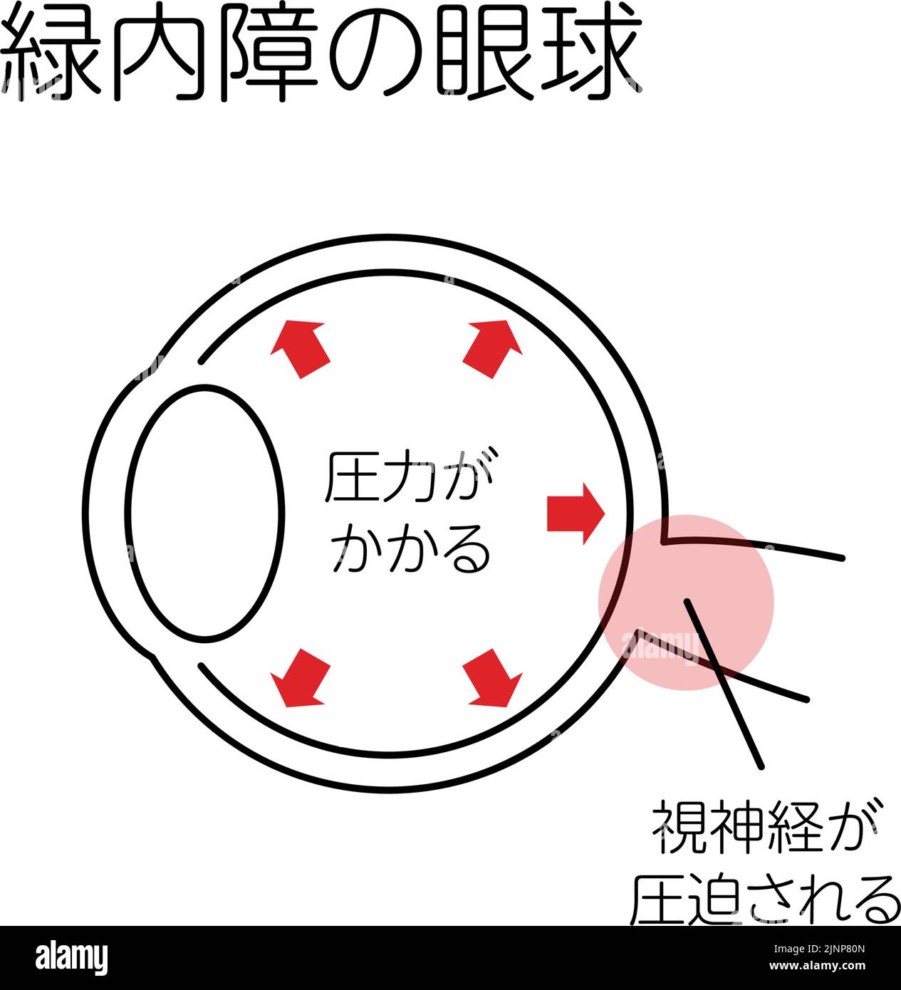 Illustration du fonctionnement du glaucome, œil de glaucome ...