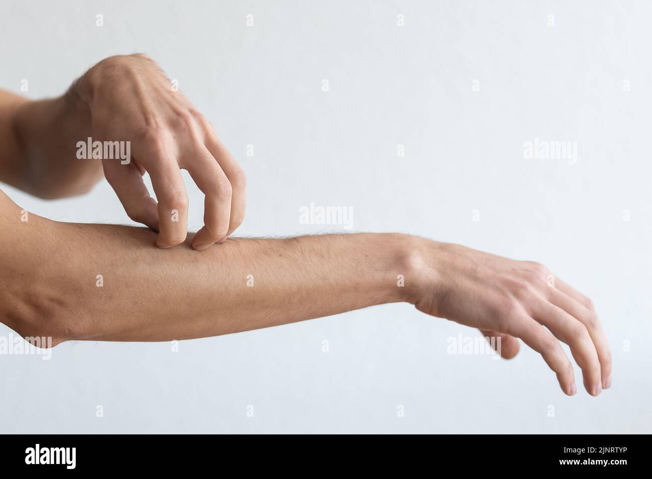 Skin rash eczema on hands Banque de photographies et d’images à haute ...