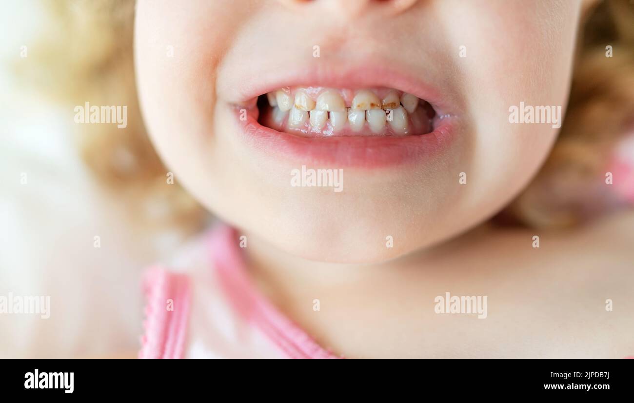 Traitement des caries dentaire Banque de photographies et d’images à ...