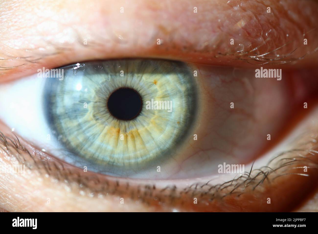 Conjunctivitis veins Banque de photographies et d’images à haute ...