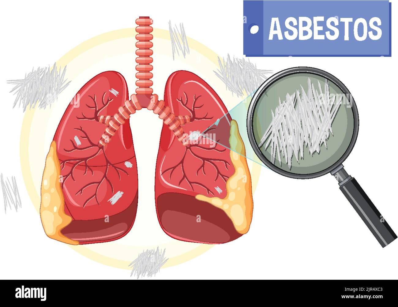 Asbestose poumons Banque de photographies et d’images à haute ...